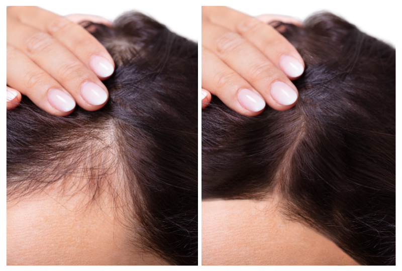 Before & After Gallery Page – Texas Hair Loss Clinic
